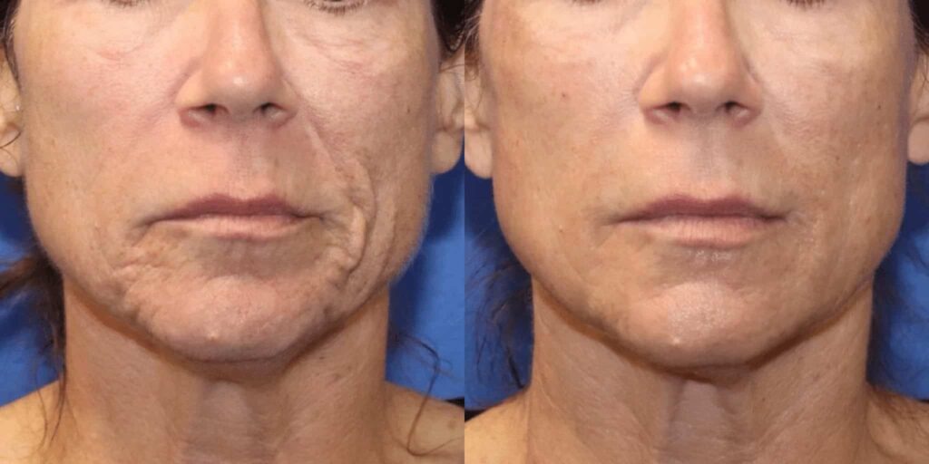 Pixel8 RF Microneedling | Improve Blemishes & Renew Skin | Non-Surgical